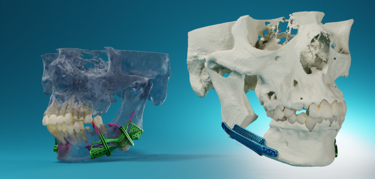 Dallas-Based MedCAD Introduces New 3D‑Printed Facial Reconstruction ...