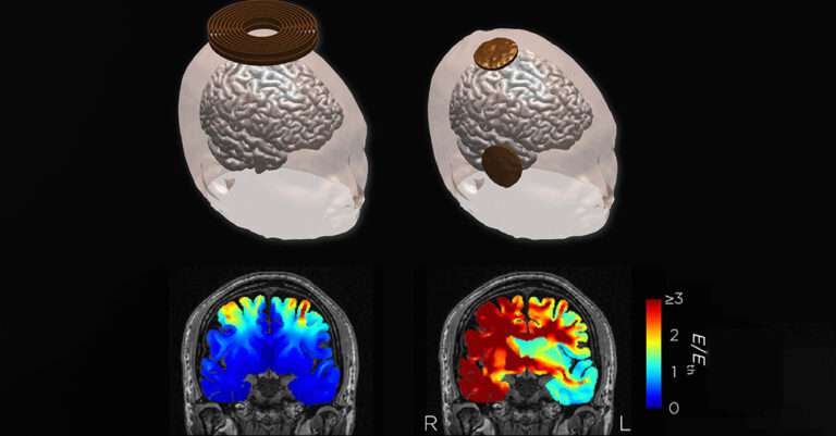UTSW Researchers Study Experimental Depression Treatment Using Magnets ...